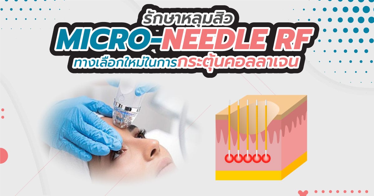 รักษาหลุมสิว Micro-needle RF ทางเลือกใหม่ในการสร้างคอลลาเจน – www.tcc.in.th